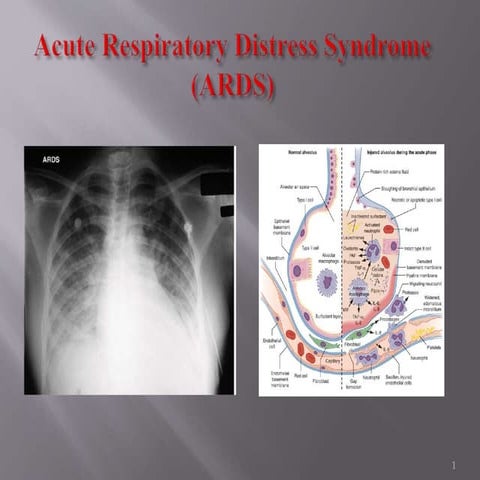 17.ARDS.ppt