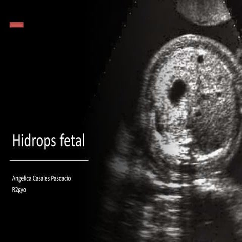 18.- Hidrops Fetal.pptx