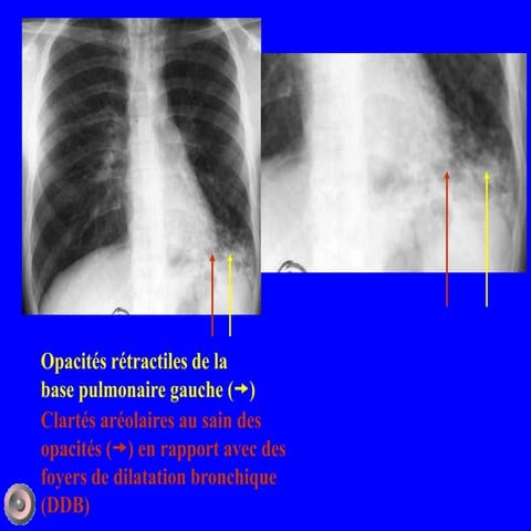 Syndrome bronchique | PDF