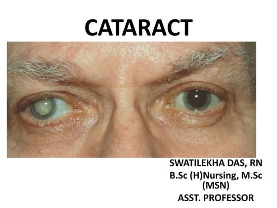 Cataract | PPT