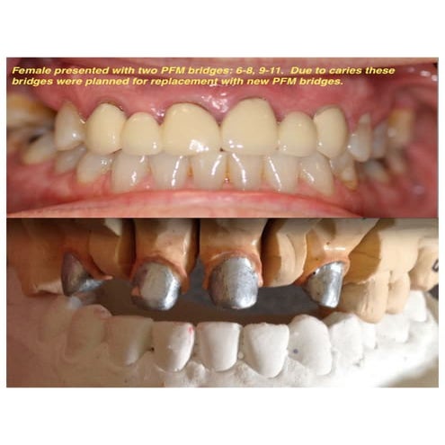 PFM Bridge Case 1 | PDF