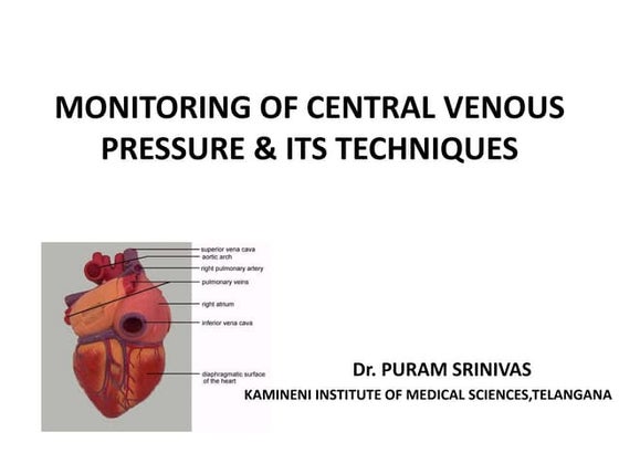 Central venous pressure monitoring | PPTX