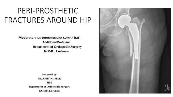 Periprosthetic Fracture (Updated) (2).pptx