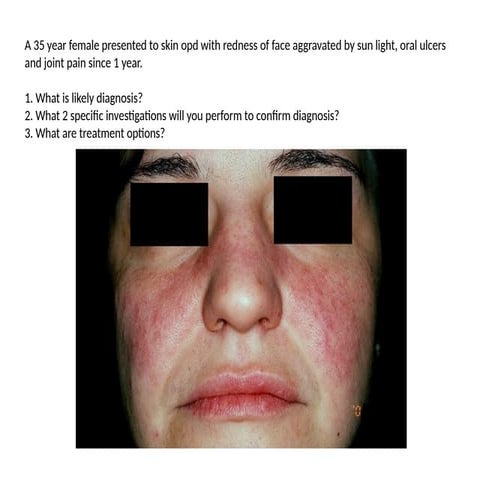 Mcq on systemic lupus erythematosus having facial rash | PPT