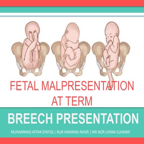 Breech presentation | PPTX