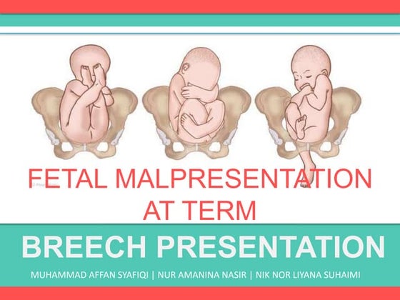 Fetal Presentation | PPT