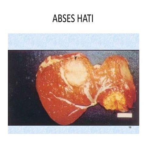 2.4.4.4b Abses Hati.pptx