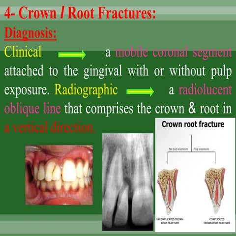 Extraction of retained roots. | PPTX