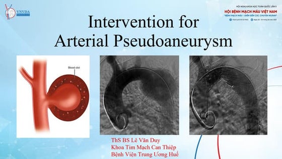 Embolization of Pseudoaneurysm slide share.pptx