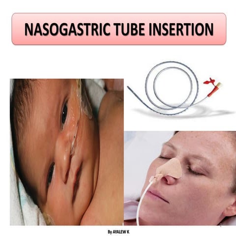 Nasogastric tube insertion | PPT
