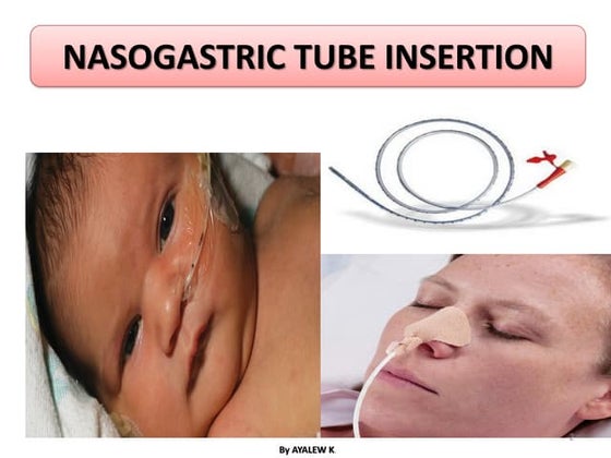 Nasogastric tube (NG tube) | PPT