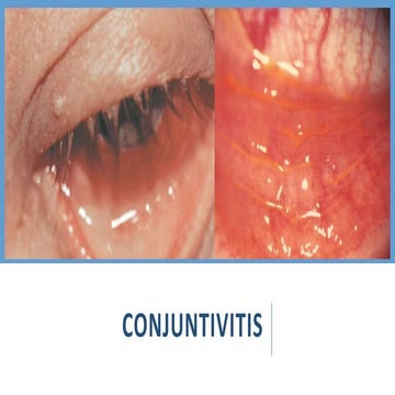 2.- CONJUNTIVITIS CLAMIDIA.pptx--.......... | PPTX