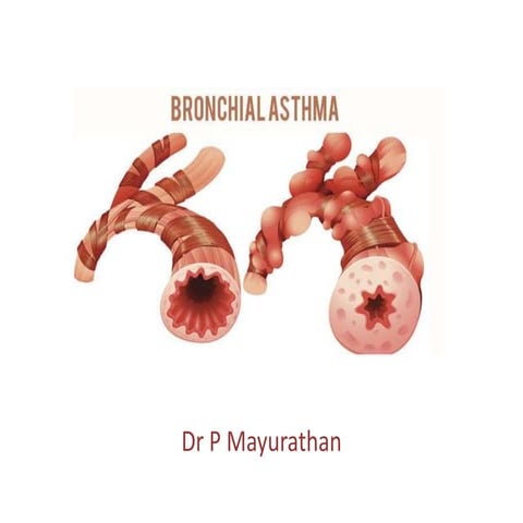 Bronchial Asthma and its clinical presentations | PPT