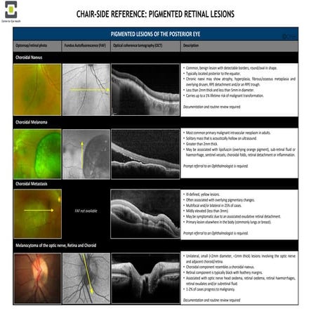 Choroidal nevus and chrpe | PPTX