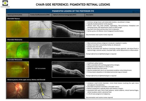 Choroidal nevus and chrpe | PPTX | Eye and Vision Conditions | Diseases ...