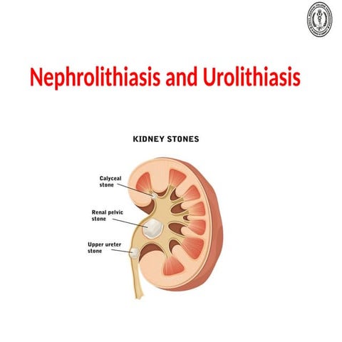 2.Nephrolithiasis and Urolithiasis 2.pptx