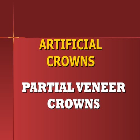 2. artificial crowns partial veneer crowns -midterm2 | PPT