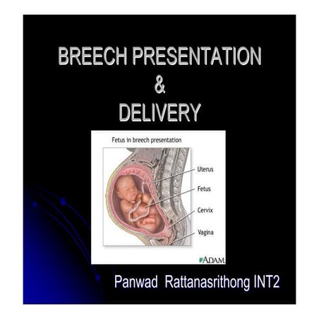 Breech Delivery | PPTX