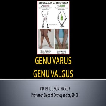 Genu varus and valgus | PPTX