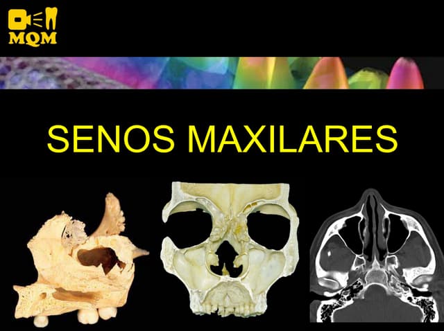 Antrostomia Maxilar | PPTX