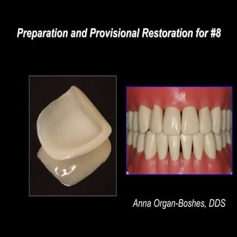 Veneer Preparation and Provisional | PPT