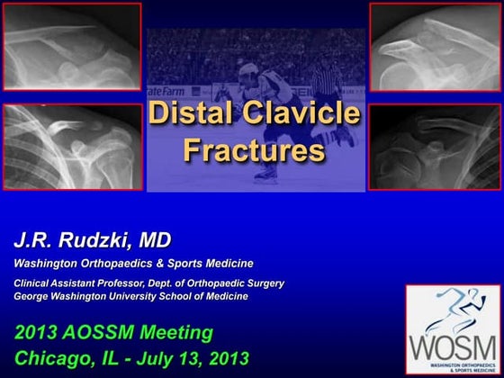 10-minute Operation : Close Reduction with Percutaneous Pinning in ...