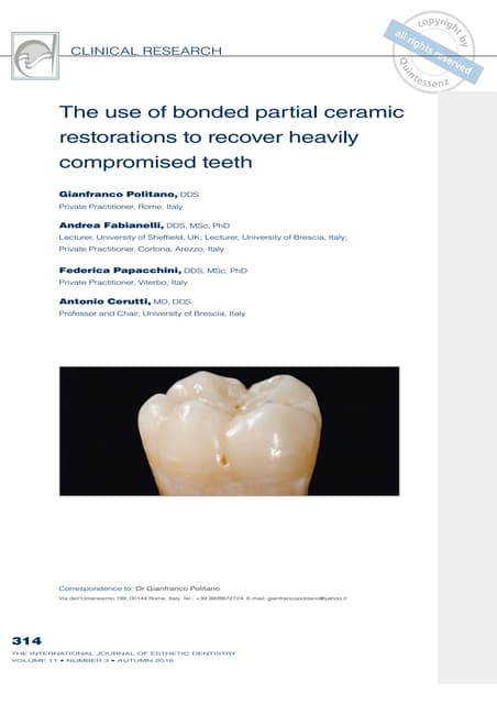 The metal ceramic crown preparation | PDF
