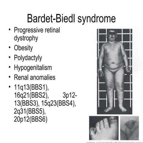 Laurence Moon Bardet Biedl Syndrome- Case Report And Review Of Liter…