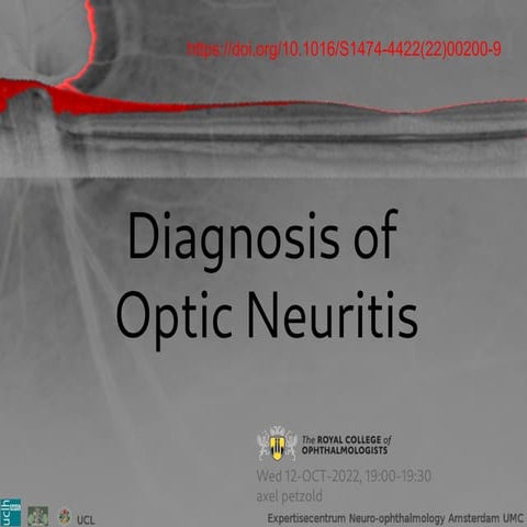 Optic Neuritis: diagnosis and classification 2022 | PPT