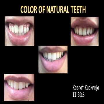 Color of Natural Teeth and shade selection in dentistry. | PPTX