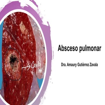 Absceso pulmonar.pptx