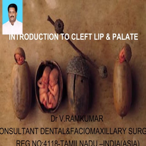 23 introduction cleft lip & palate | PPT