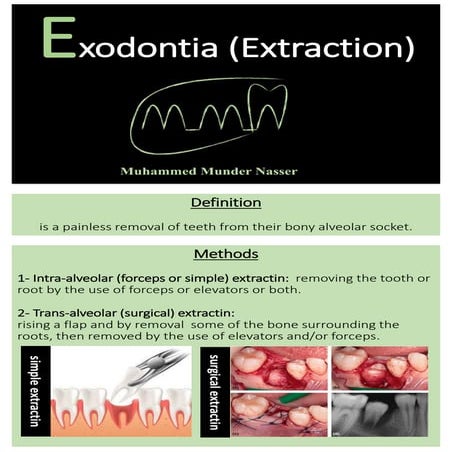 Exodontia (Extraction) | PDF