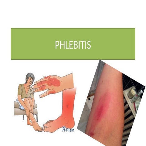 POWER POINT PHLEBITIS EDUKASI DAN TANDA PHLEBITIS | PPTX