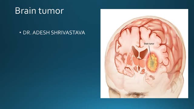 Central nervous system tumors | PPTX