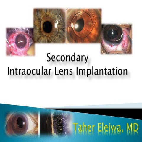 secondary IOL implantation | PPTX