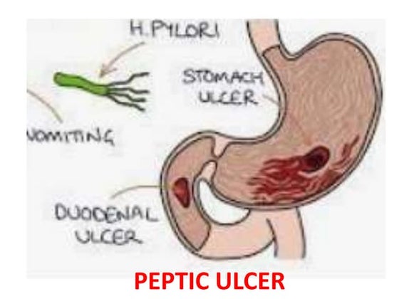 Pathophysiology of Peptic ulcer | PDF