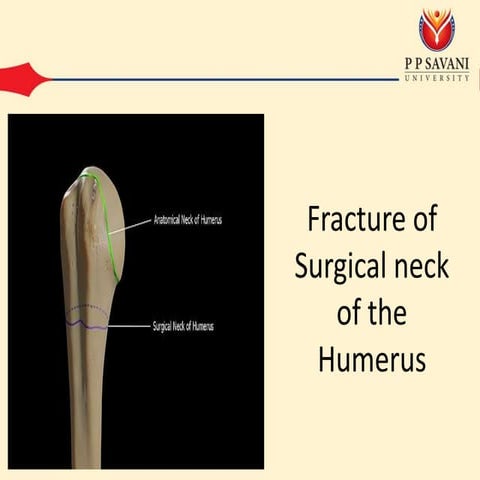 3. Fracture of Greater Tuberosity and Surgical Neck of Humerus | PPT