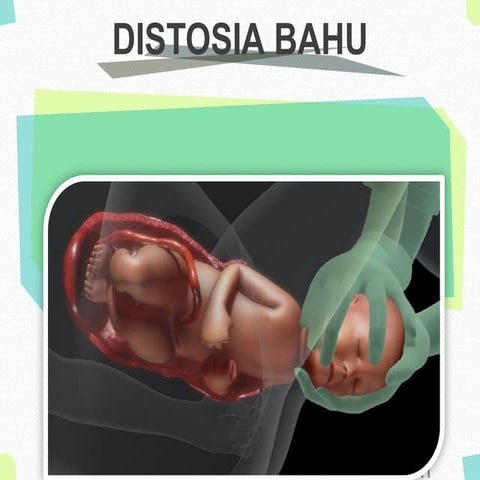 3. menolong persalinan dengan distosia bahu | PPTX