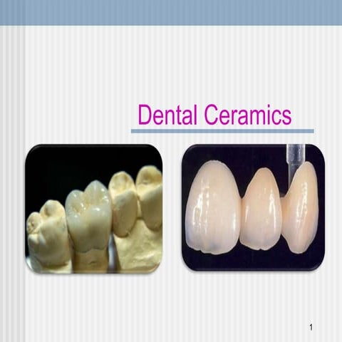 Dental Ceramics and Porcelain fused to metal | PPTX