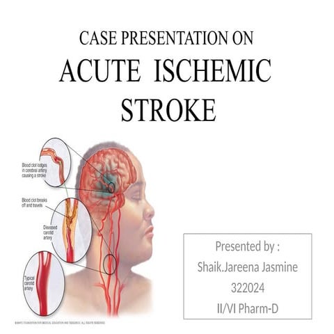 322024 acute ischemic strokjtyjgjye.pptx