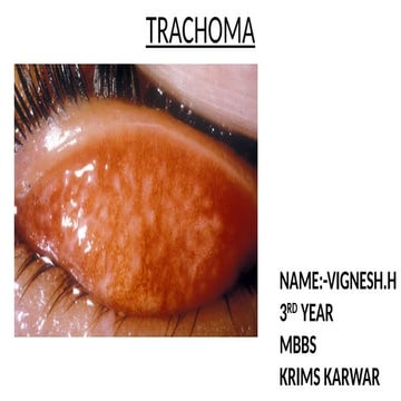 TRACHOMA- DIAGNOSIS AND MANAGEMENT | PPTX