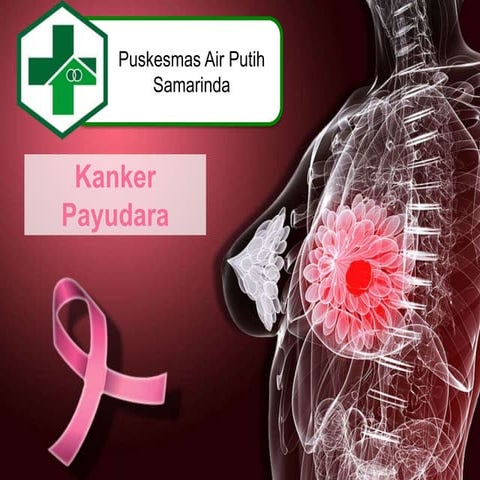368629235-Presentasi-Kanker-Payudara-pptx-pptx.pptx