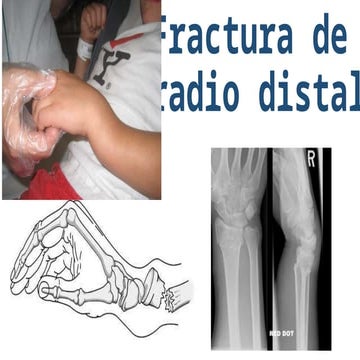 Clasificación Frykman y Fernández Fx Radio Distal | PPTX