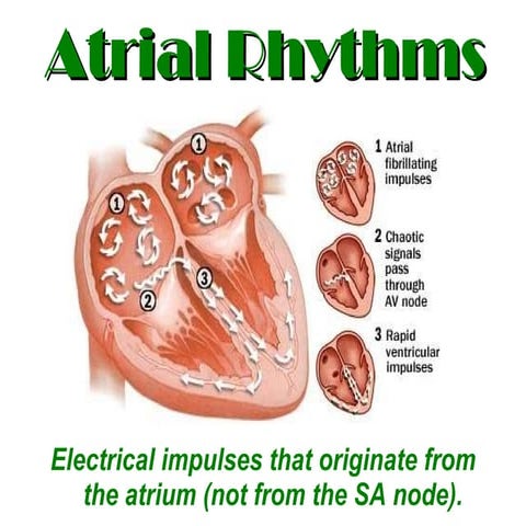 3a atrial rhythms | PPT