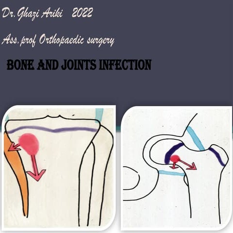 3_Bone and joints infection lecture2022.pptx