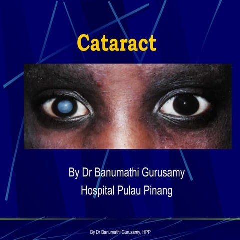 Cataract | PPT