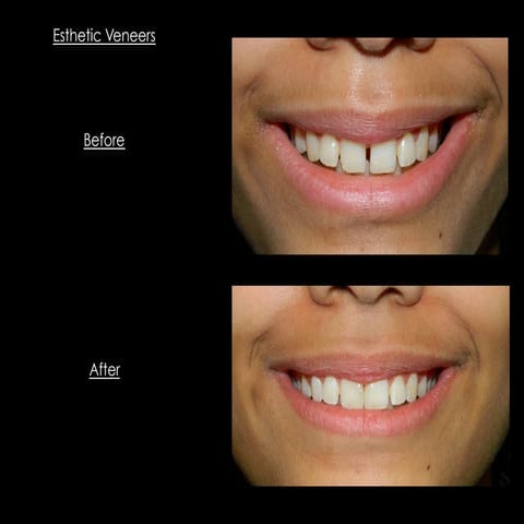 Smile Correction and Esthetic Enhancement | PDF