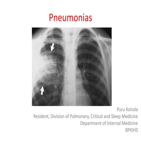 Pneumonia | PPT