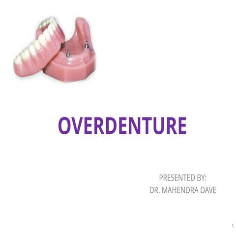Overdentures in prosthodontic and implant dentistry | PPTX